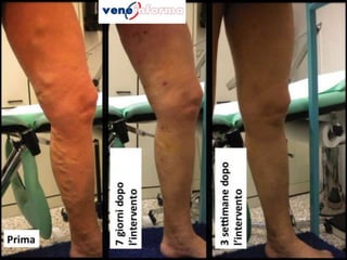 Big Varicose Veins treated with CHIVA Method | PPTX