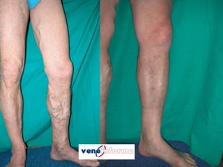 Big Varicose Veins treated with CHIVA Method | PPTX