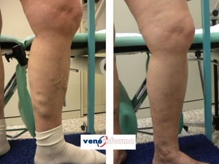 Big Varicose Veins treated with CHIVA Method | PPTX