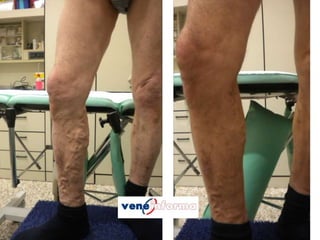 Big Varicose Veins treated with CHIVA Method | PPTX | Heart and ...