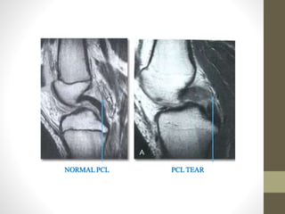MRI in orthopaedics | PPTX