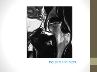 MRI in orthopaedics | PPTX