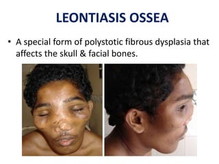 a case of fibrous dysplasia | PPT