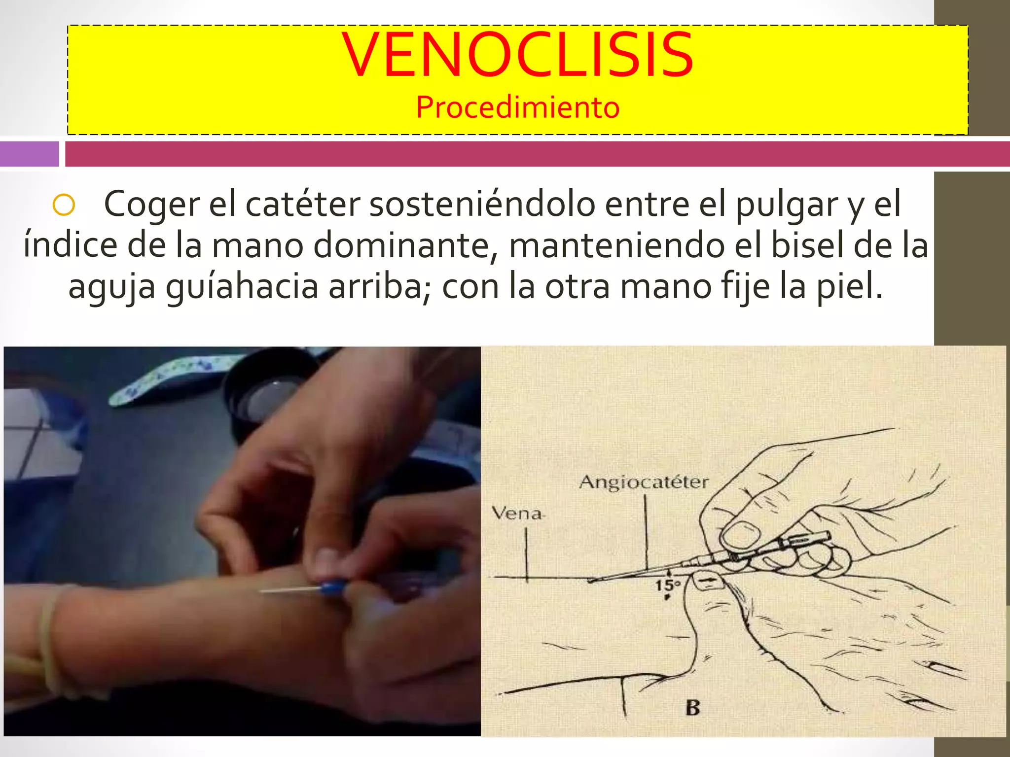 VENOCLISIS | PPTX