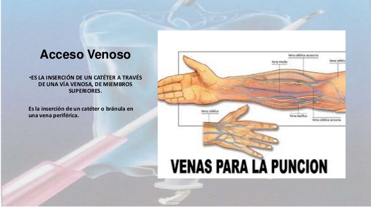 Venoclisis acceso venoso periferico