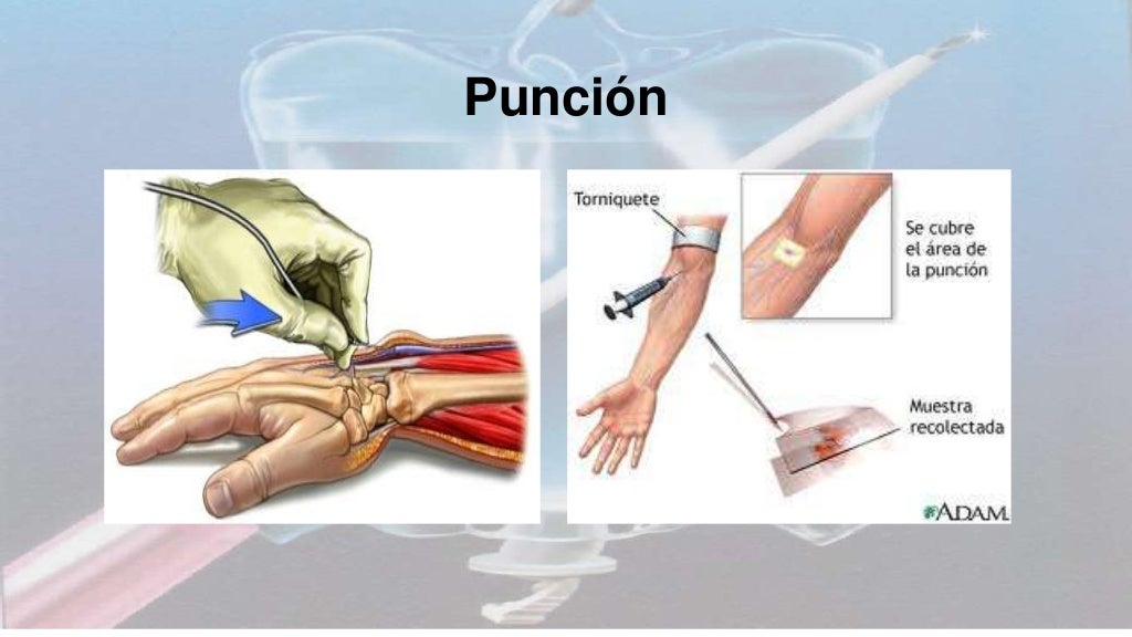 Venoclisis acceso venoso periferico
