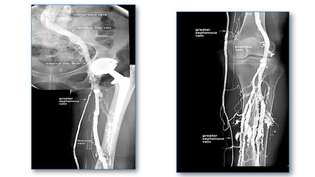 Venography | PPTX | Heart and Cardiovascular Diseases | Diseases and ...