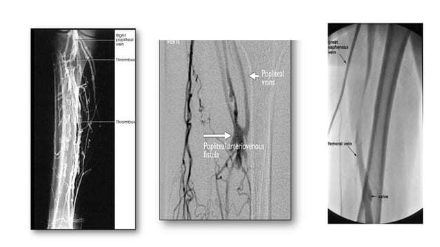 Venography | PPTX | Heart and Cardiovascular Diseases | Diseases and ...