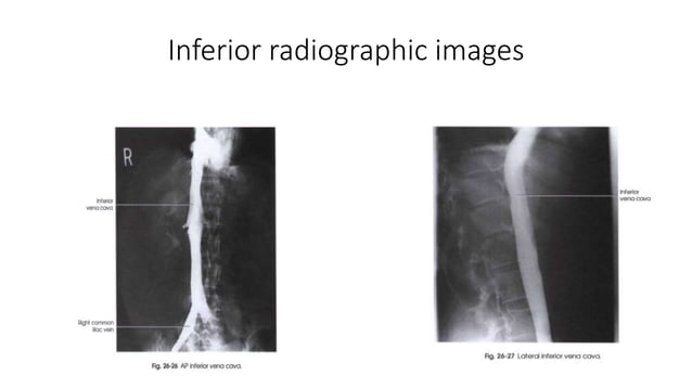 Venography | PPTX | Heart and Cardiovascular Diseases | Diseases and ...