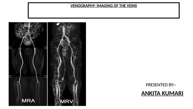 VENOGRAPHY- investigation of veins pathology.pptx