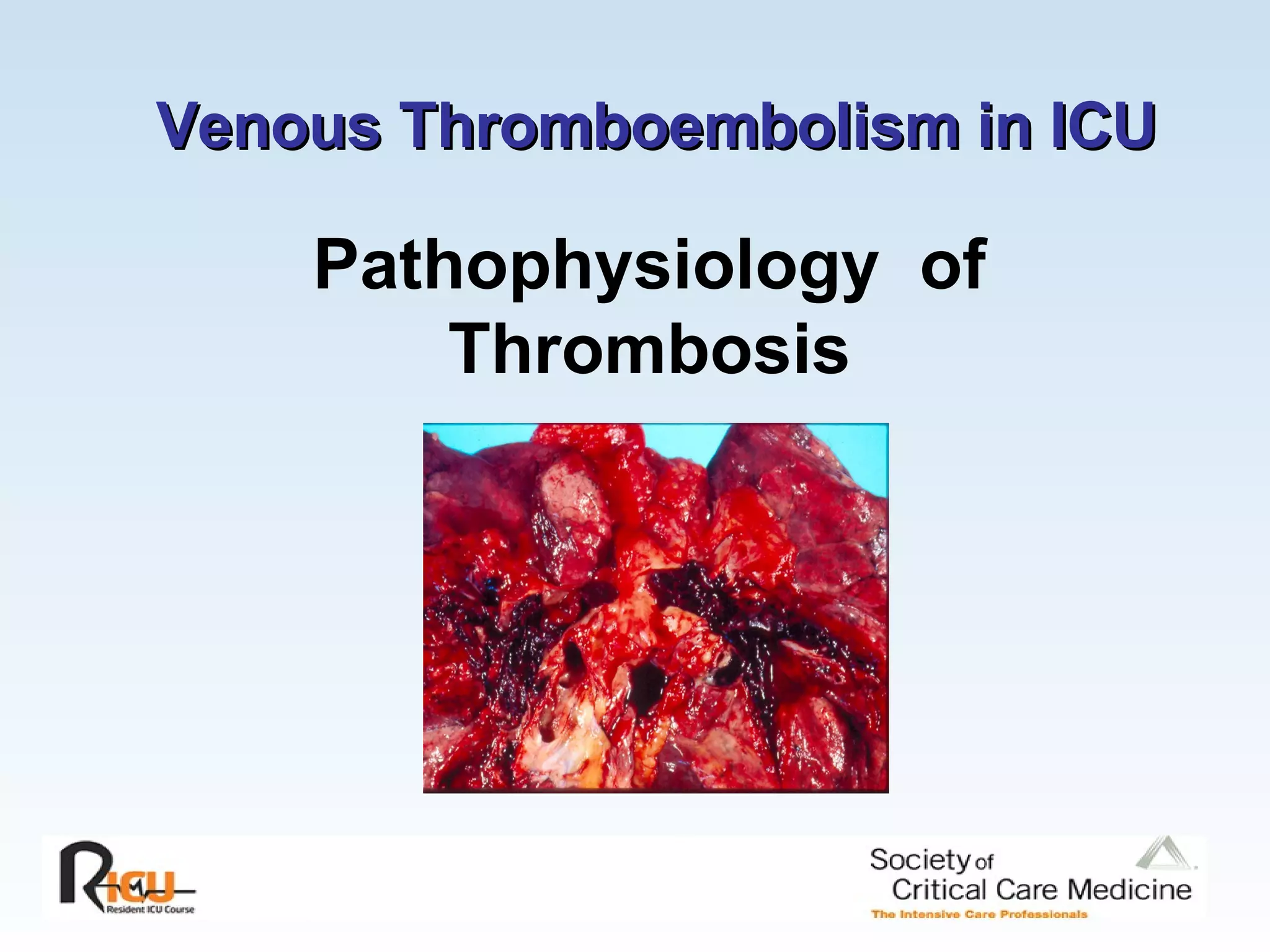 Venous Thromboembolism | PPT