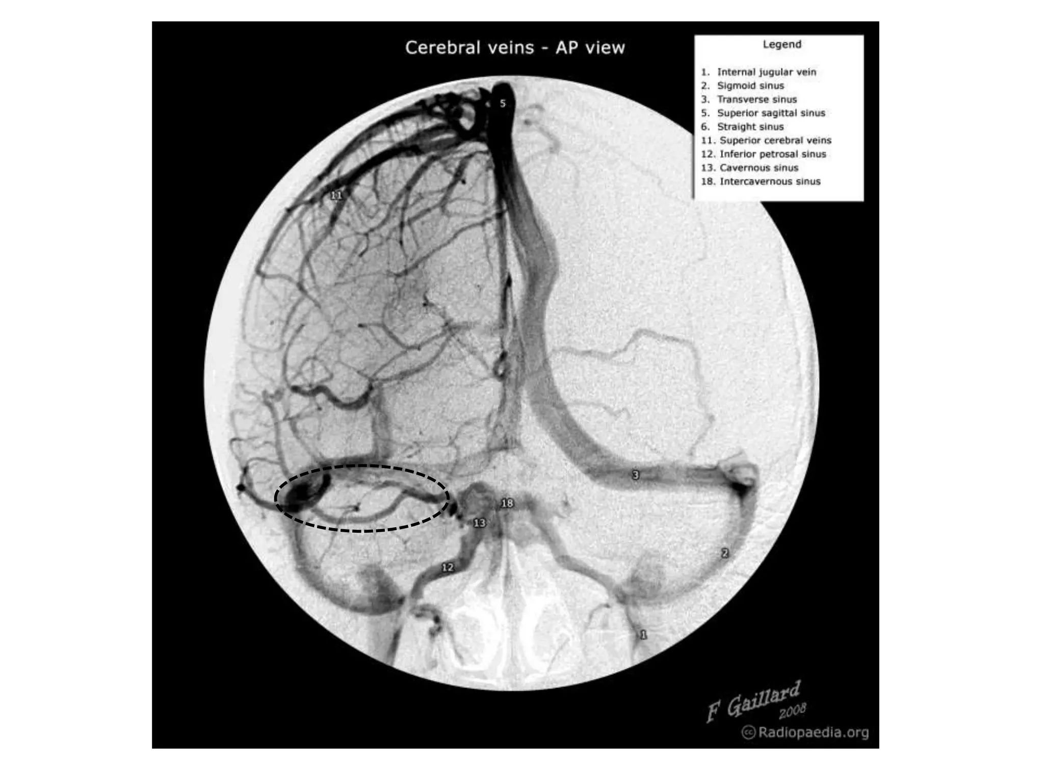 Venous anatomy of brain - Radiology | PPTX