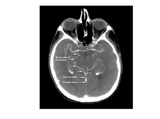 Venous anatomy of brain - Radiology | PPT