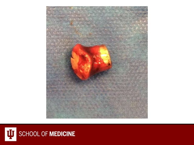 Venous Bullet Embolization Presentation Final.pptx