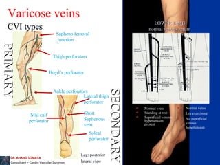 Webinar on Varicose Veins - Venous Disease : Hinduja Hospital | PPT