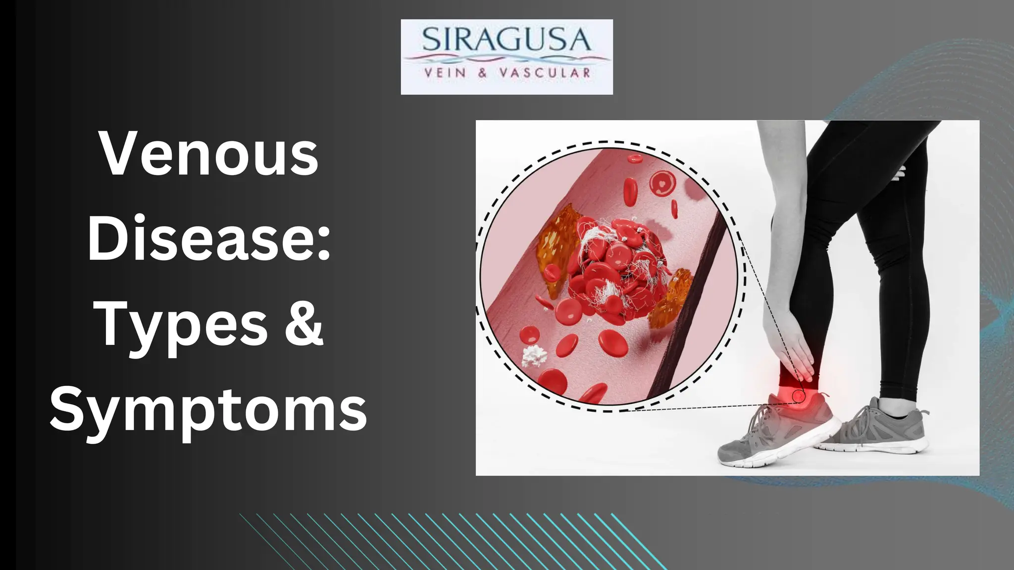 Venous Disease Types & Symptoms.pptx