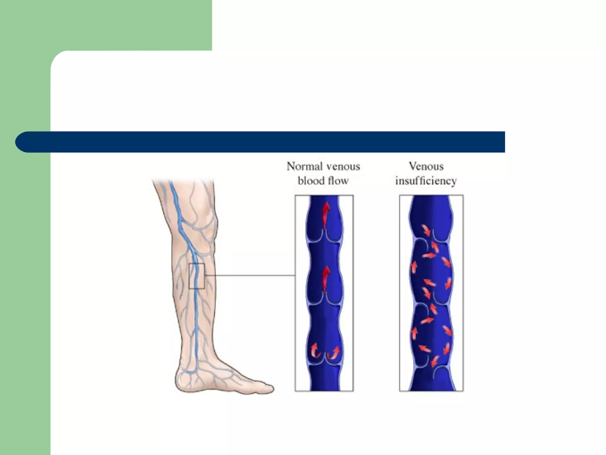 Venous Disorders | PPT