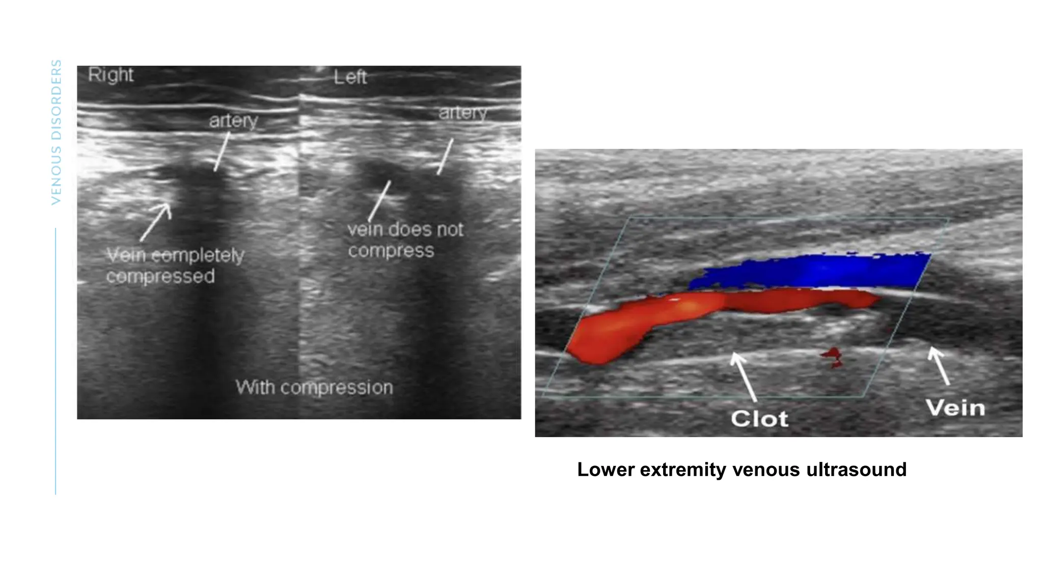 Venous disorders of the lower limbs, general surgery | PPTX