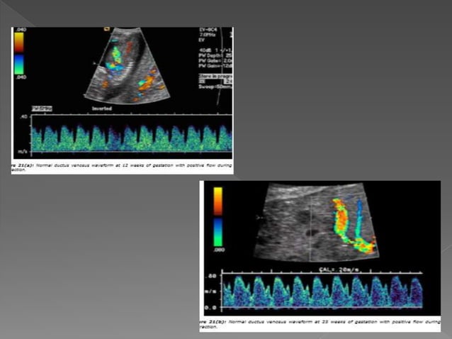 Venous doppler | PPTX | Pregnancy | Reproductive Health