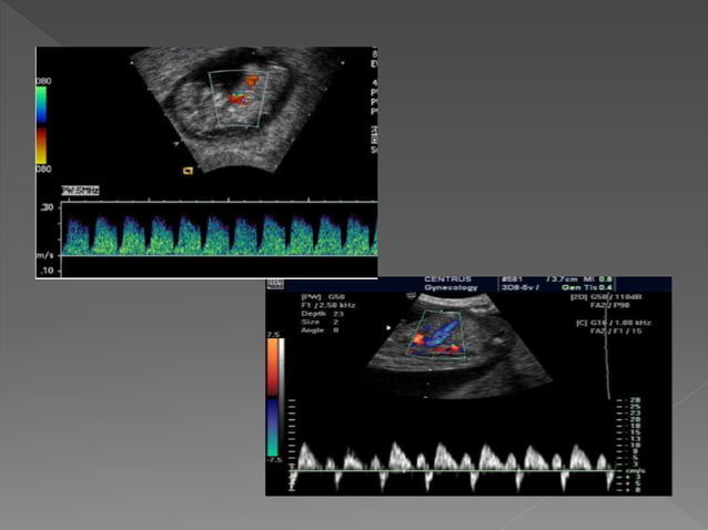 Venous doppler | PPTX | Pregnancy | Reproductive Health