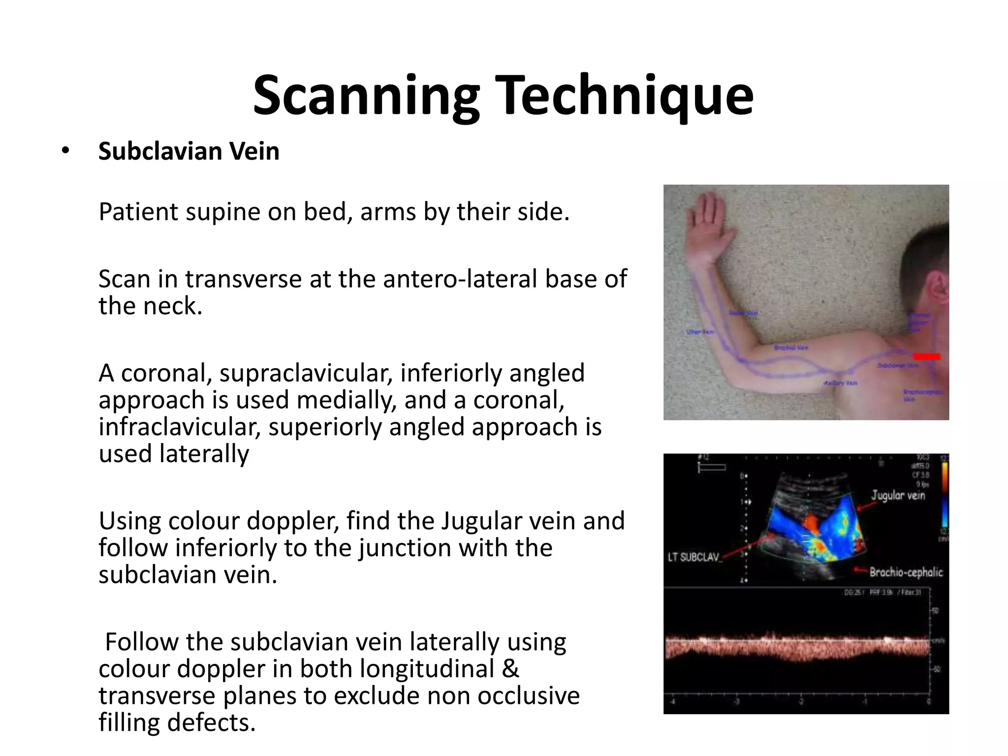 Venous Doppler upper limb | PPTX