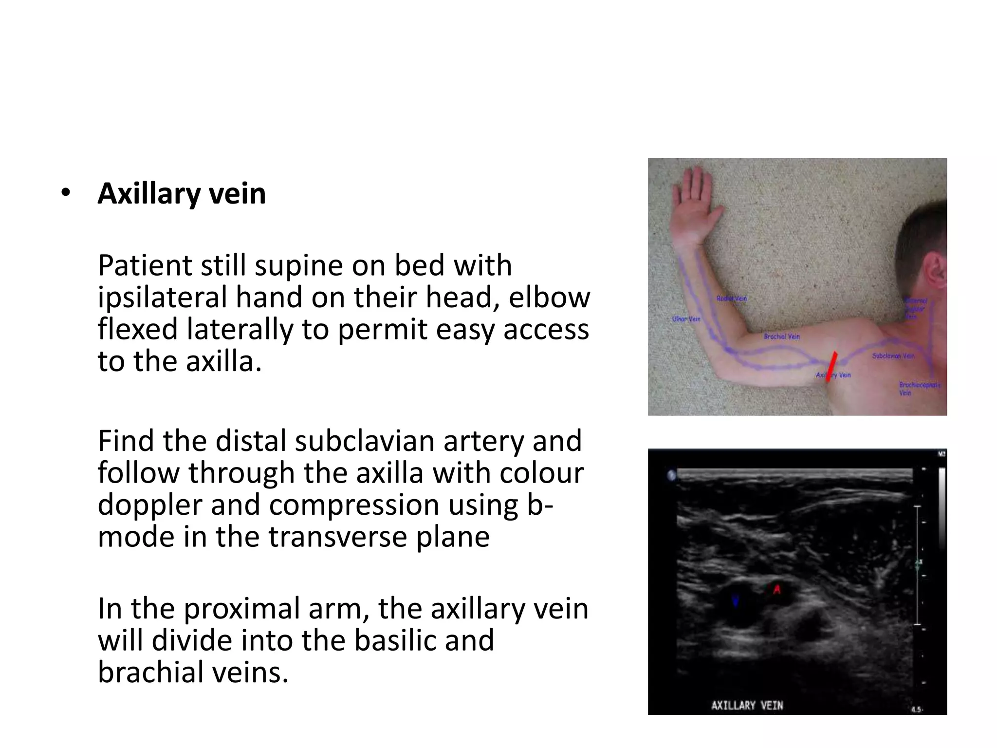Venous Doppler upper limb | PPTX