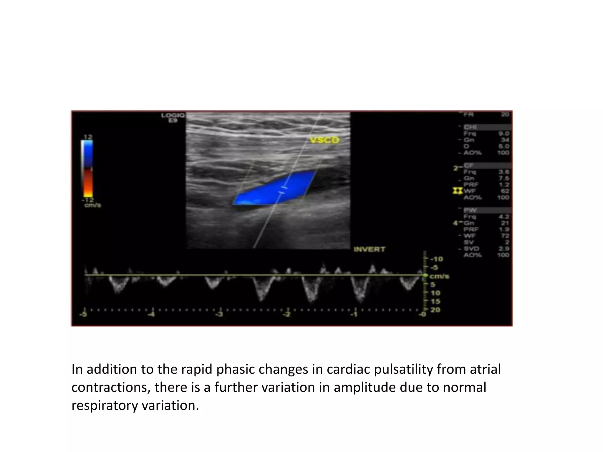 Venous Doppler upper limb | PPTX