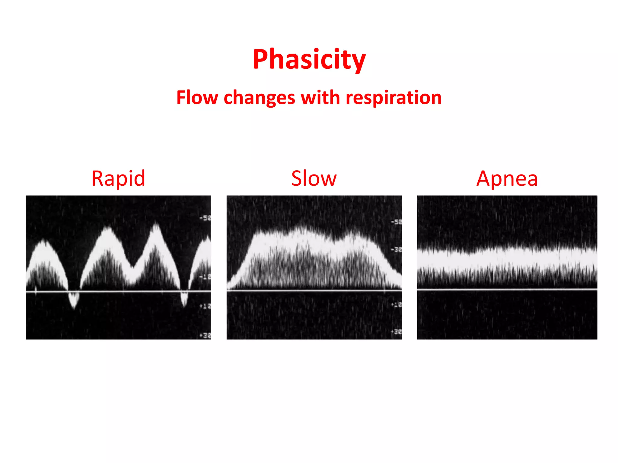 Venous Doppler upper limb | PPTX