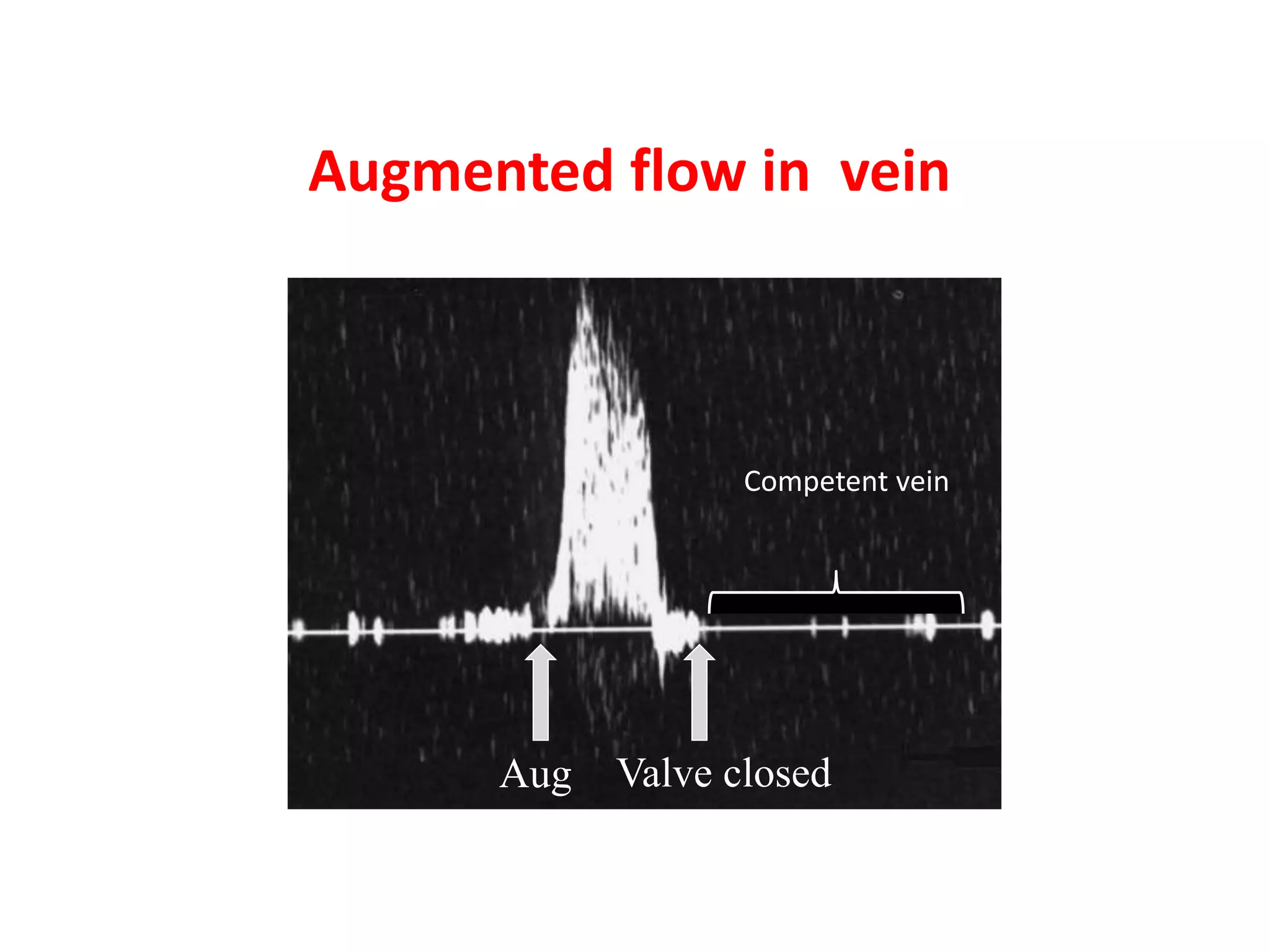 Venous Doppler upper limb | PPTX