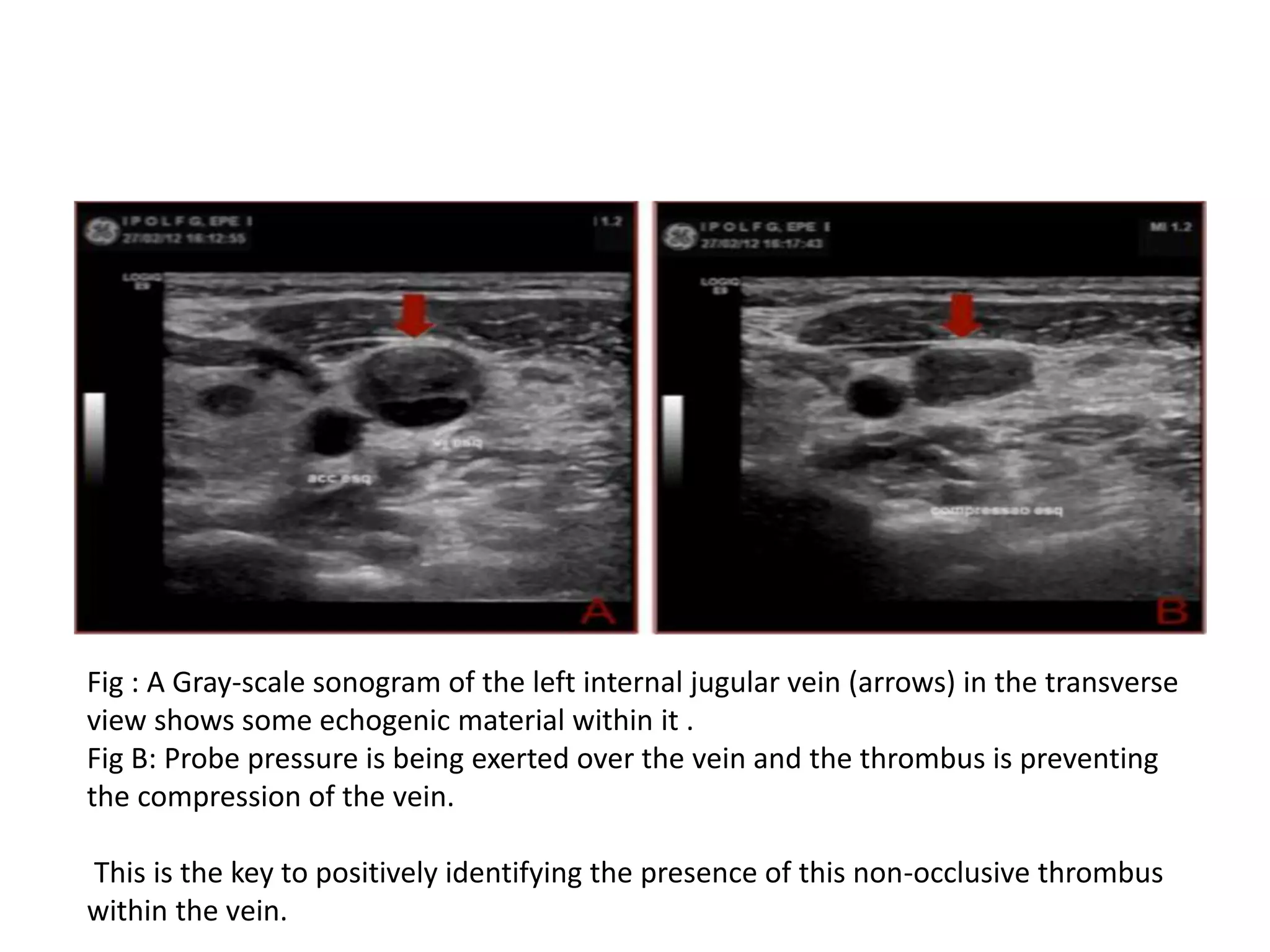 Venous Doppler upper limb | PPTX