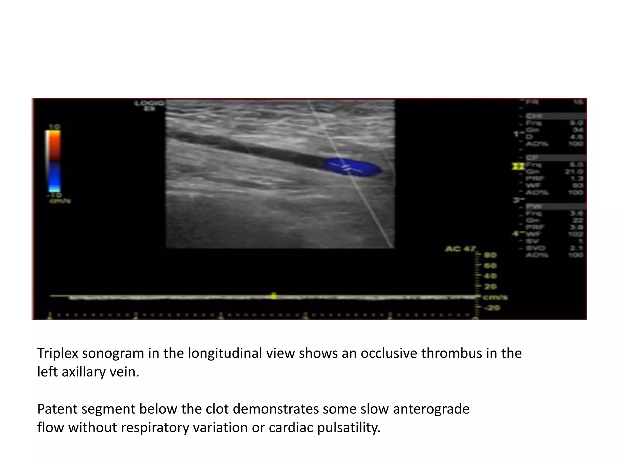 Venous Doppler upper limb | PPTX