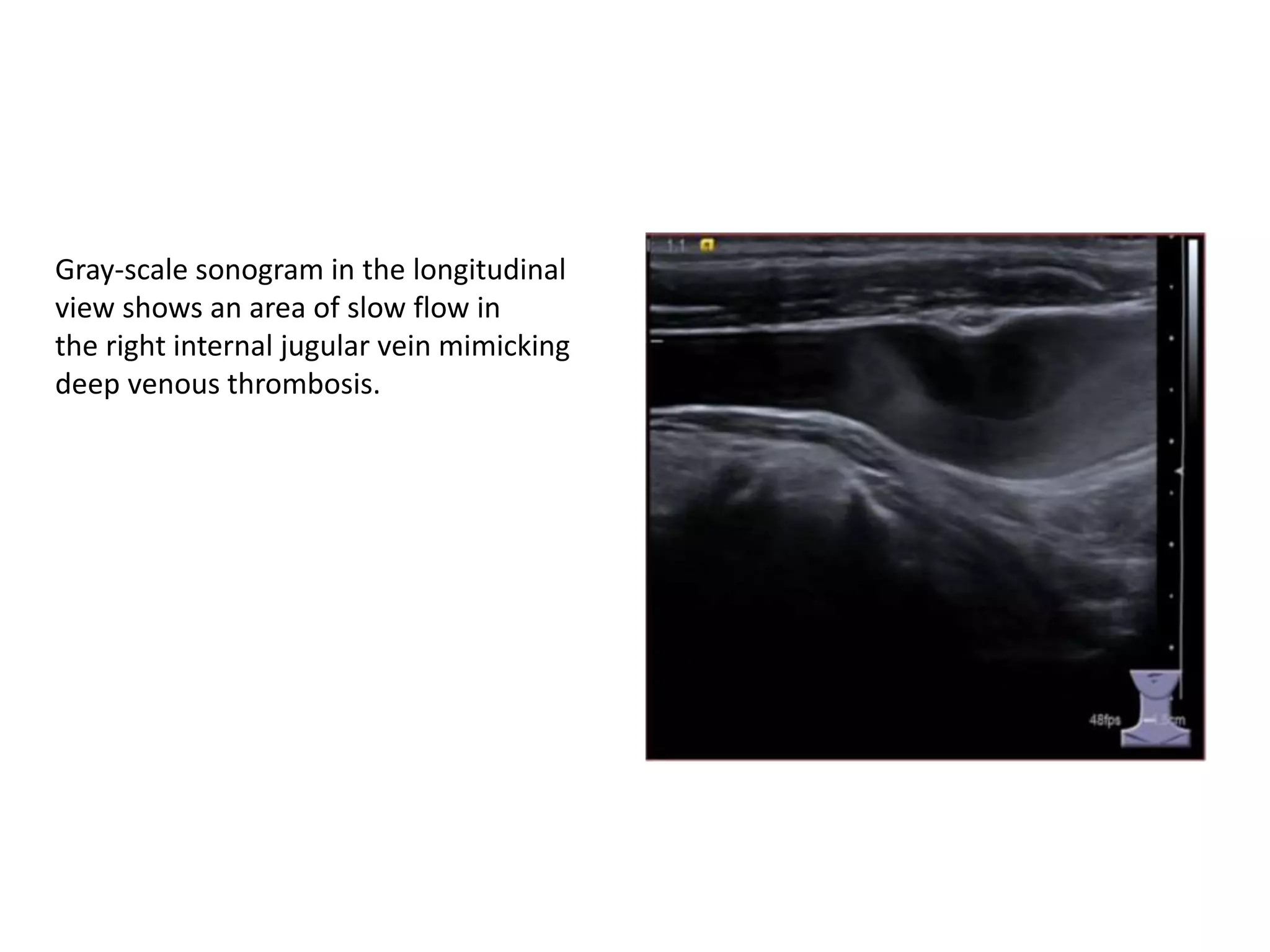 Venous Doppler upper limb | PPTX