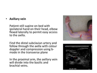 Venous Doppler upper limb | PPTX
