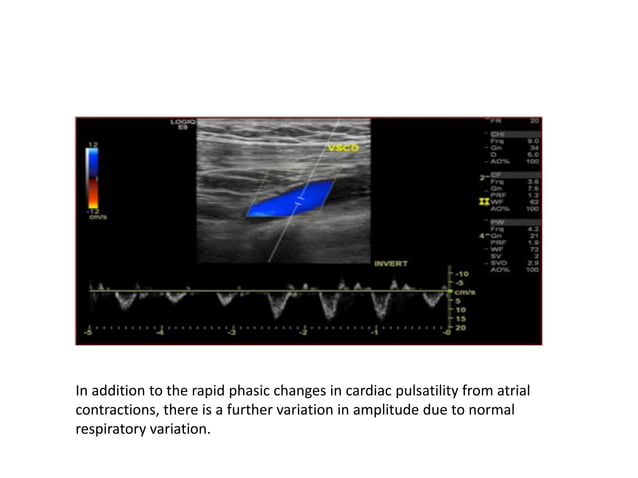 Venous Doppler upper limb | PPTX