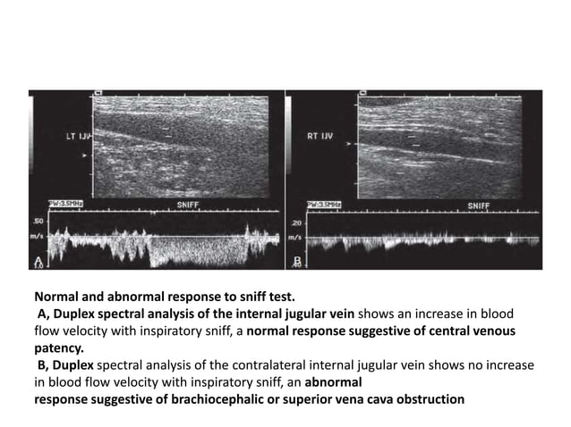 Venous Doppler upper limb | PPTX