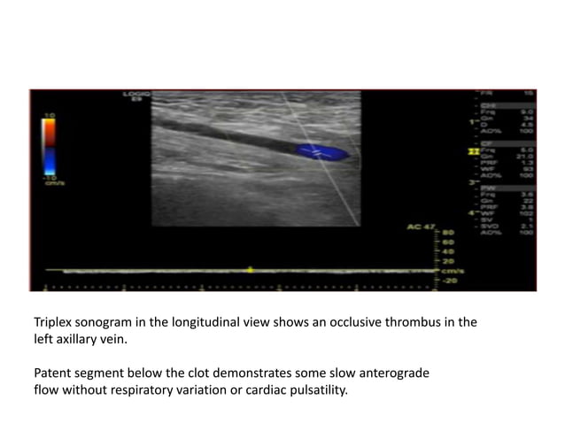 Venous Doppler upper limb | PPTX