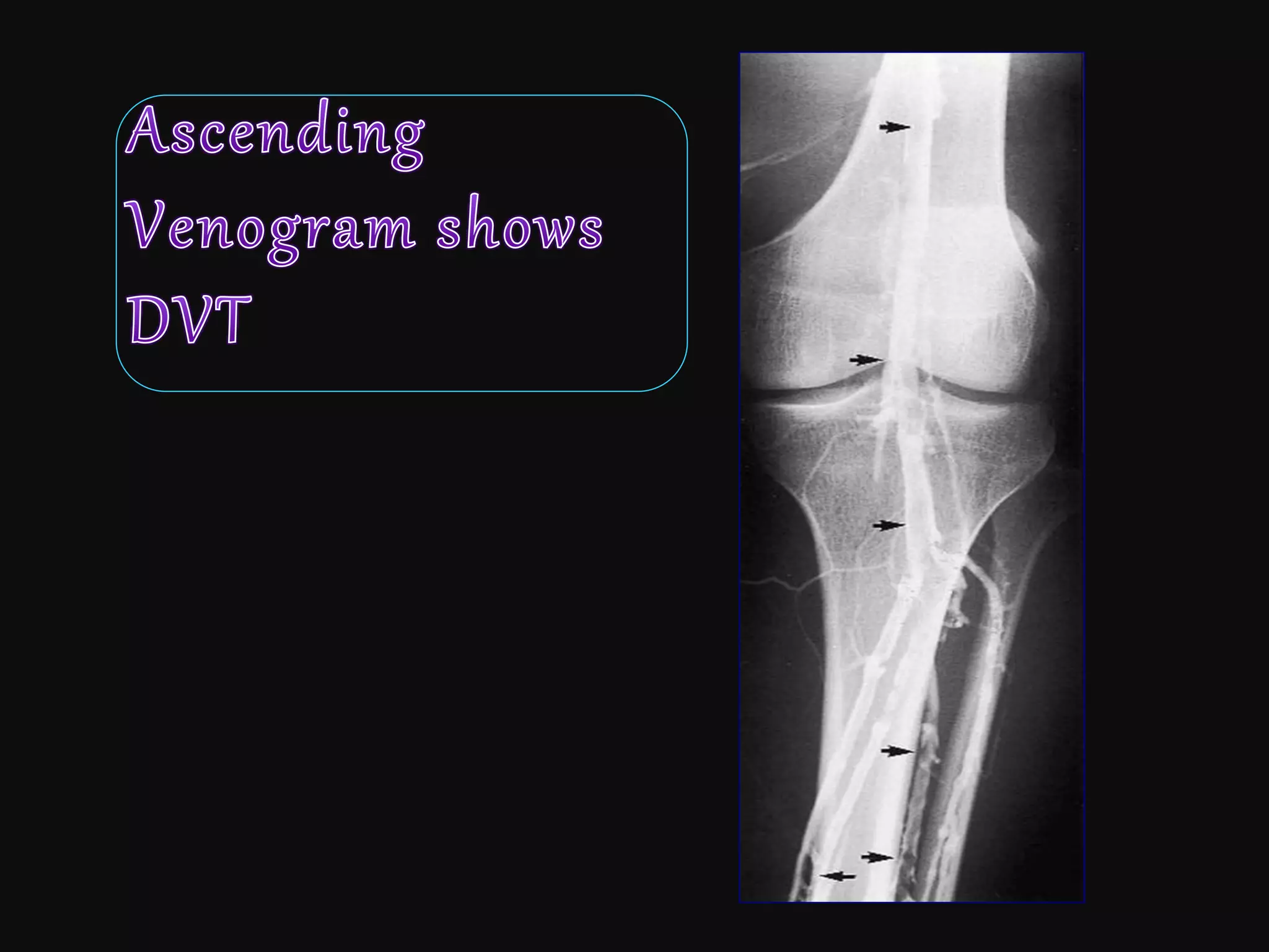 Venous drainage of lower limb ppt | PPTX