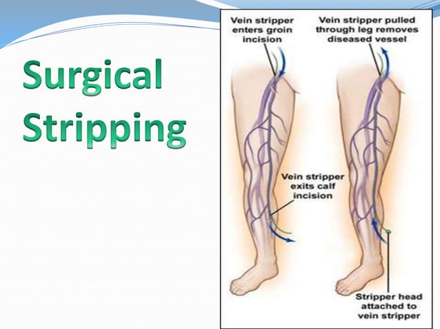 Venous drainage of lower limb ppt | PPTX