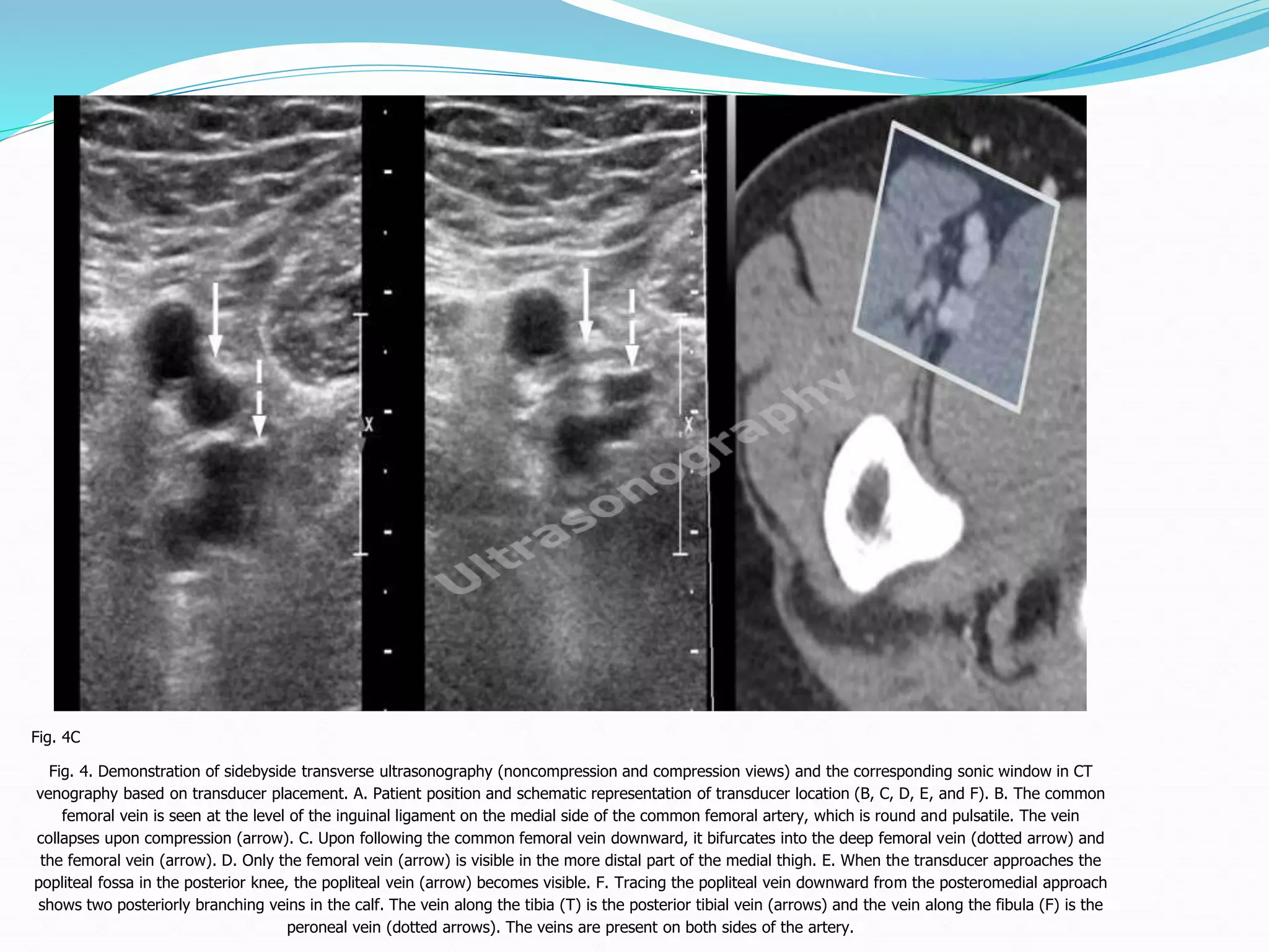 VENOUS DRAINAGE OF THE LOWER LIMBS.ppt