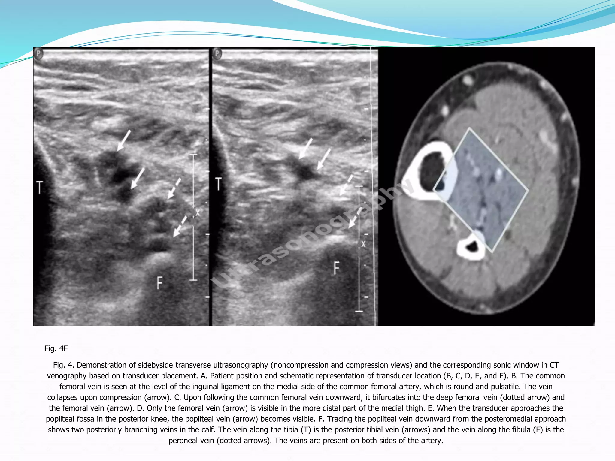 VENOUS DRAINAGE OF THE LOWER LIMBS.ppt