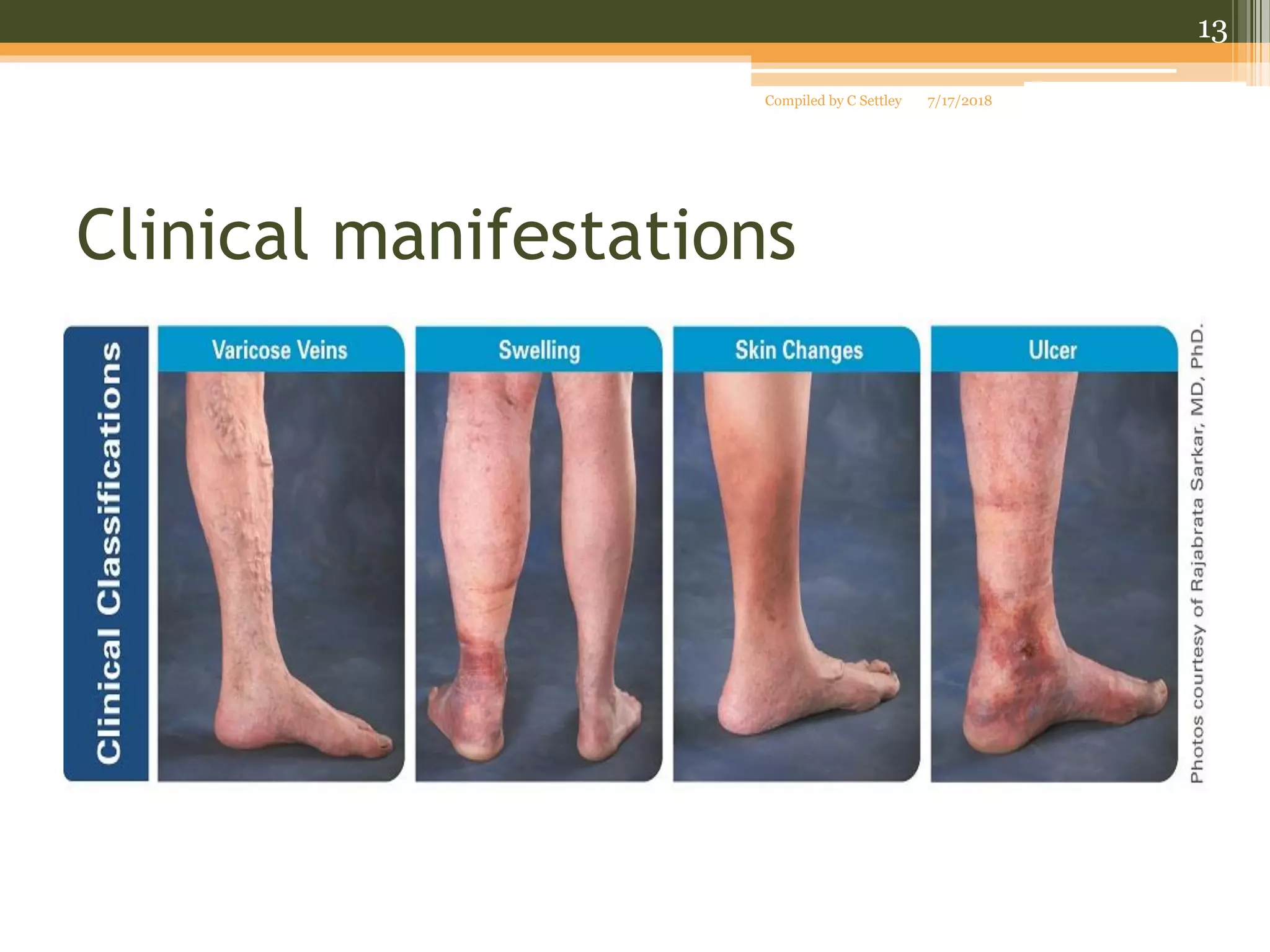 Venous stasis ulcers | PDF