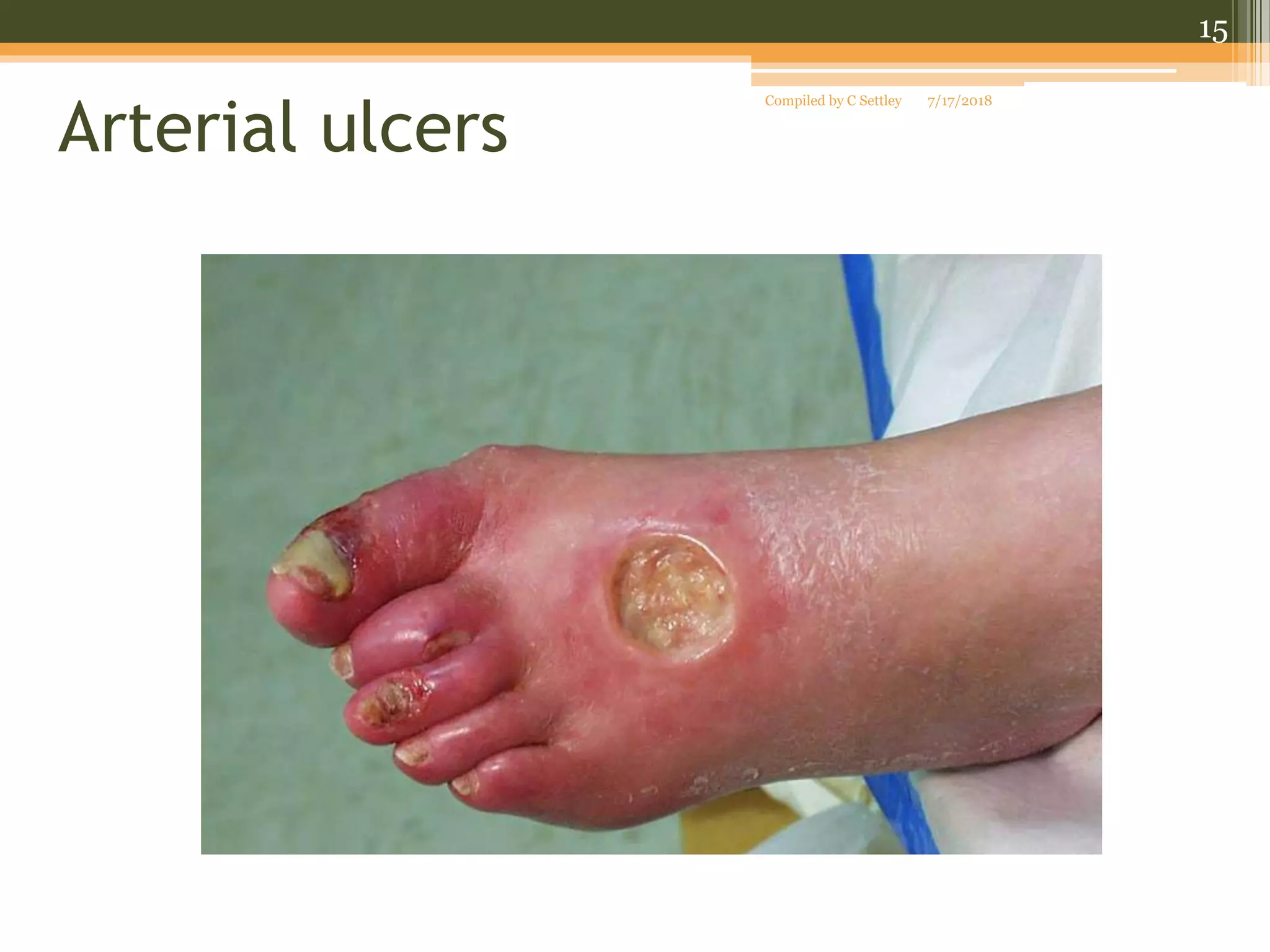 Venous stasis ulcers | PDF