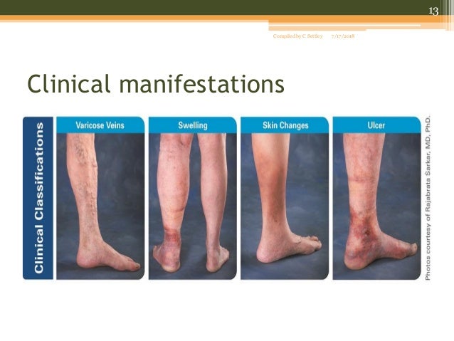 Venous stasis ulcers