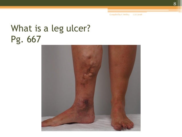 Venous stasis ulcers