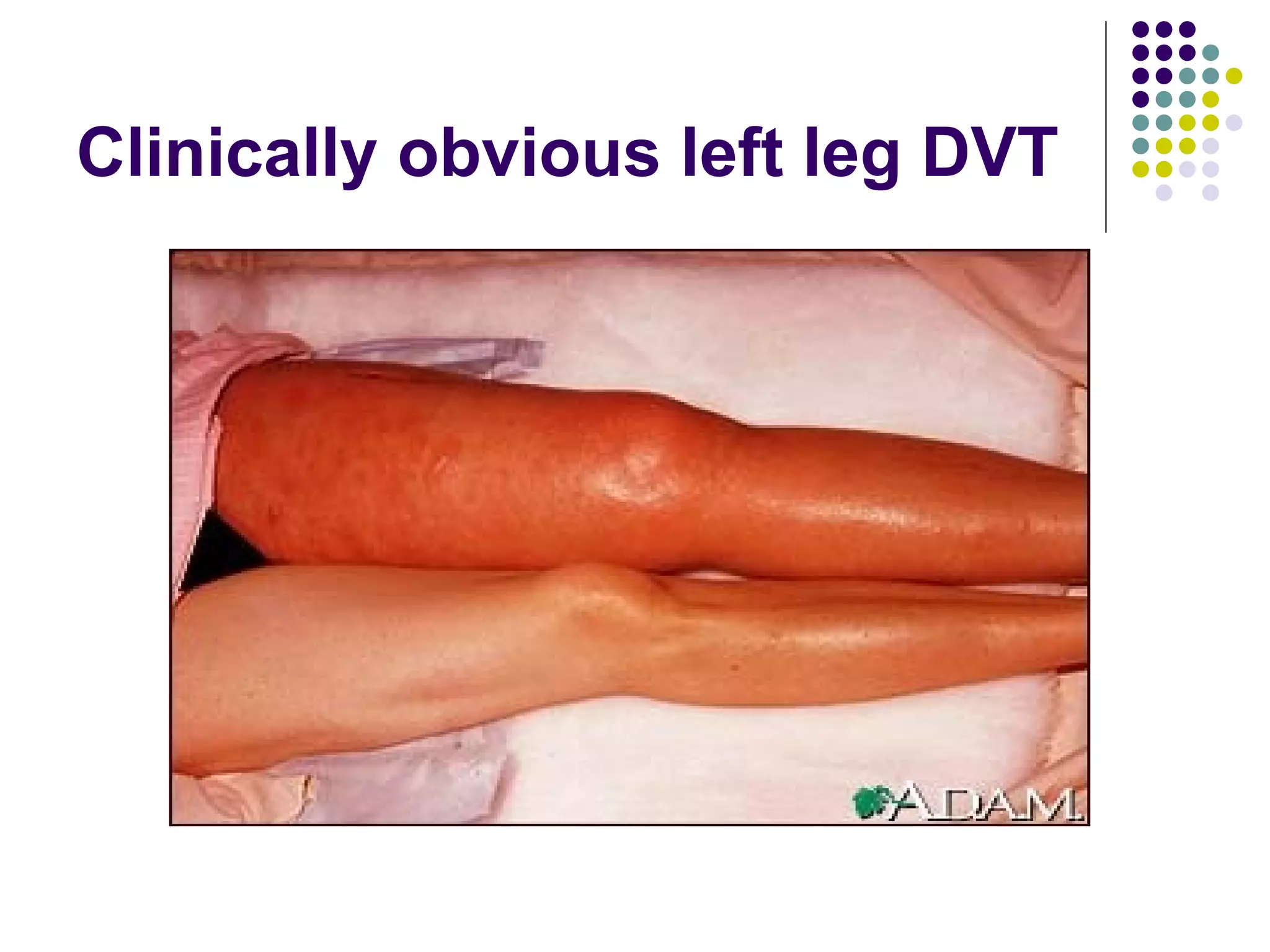 Venous Thromboembolism in Obstetrics | PPT