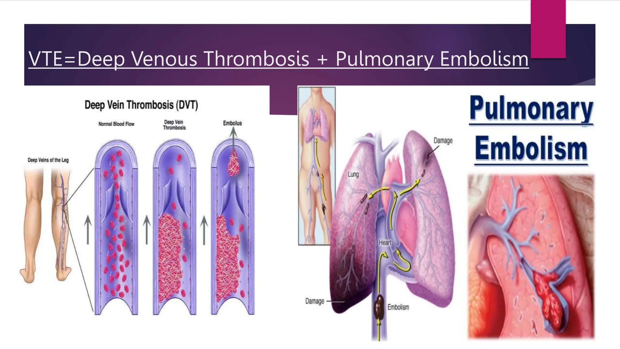 VENOUS THROMBOEMBOLISM (VTE) PRESENTATION.pptx
