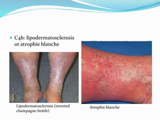 Venous ulceers | PPTX