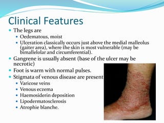 Venous ulceers | PPT