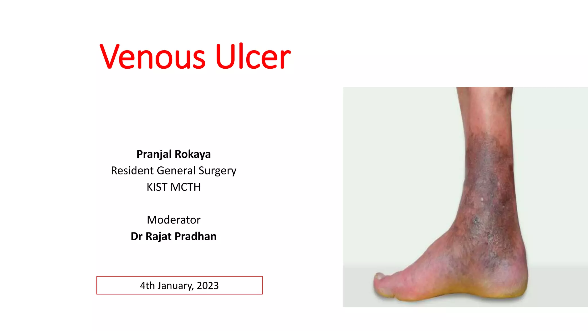 Venous ulcer | PPTX