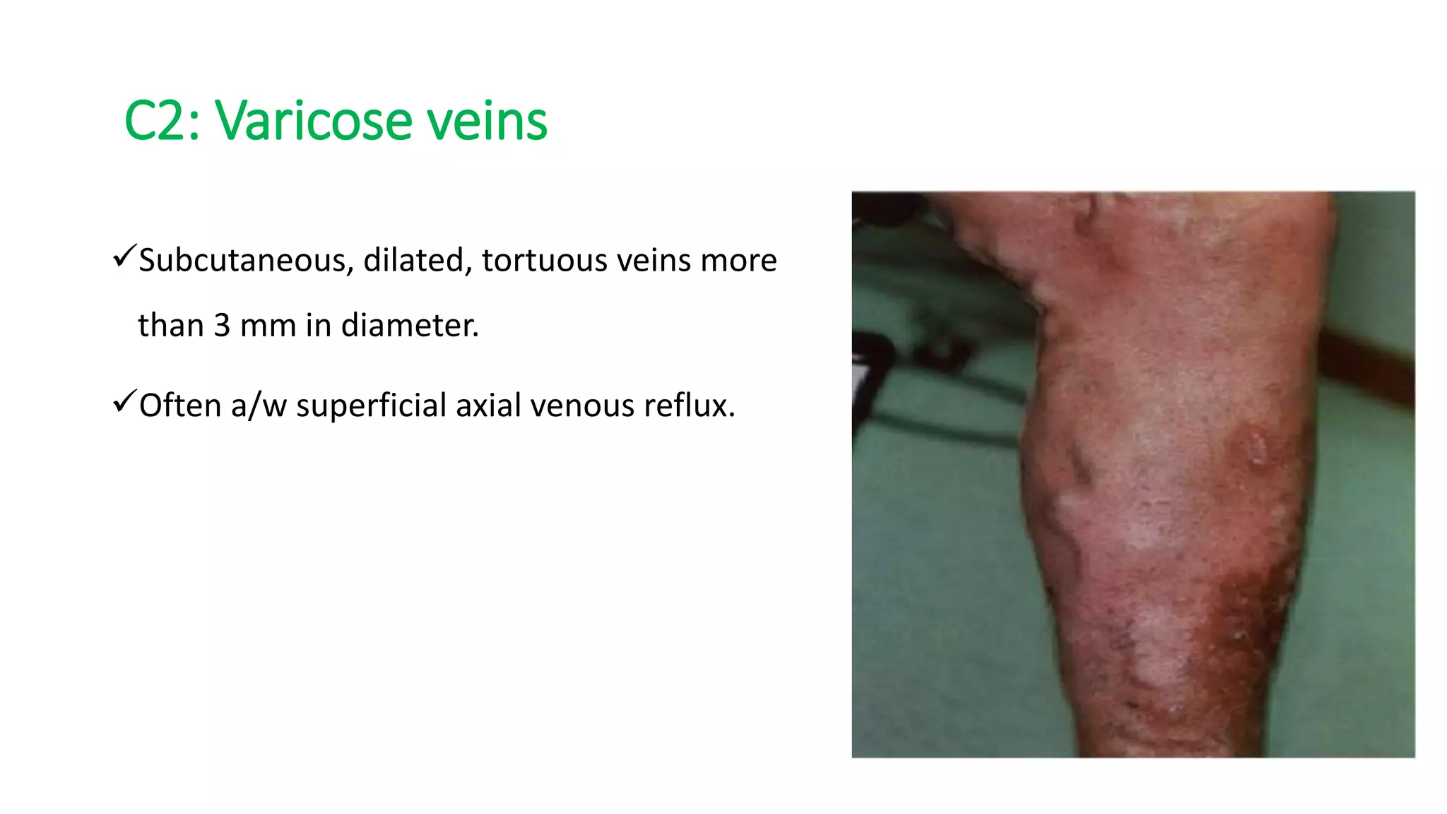Venous ulcer | PPTX
